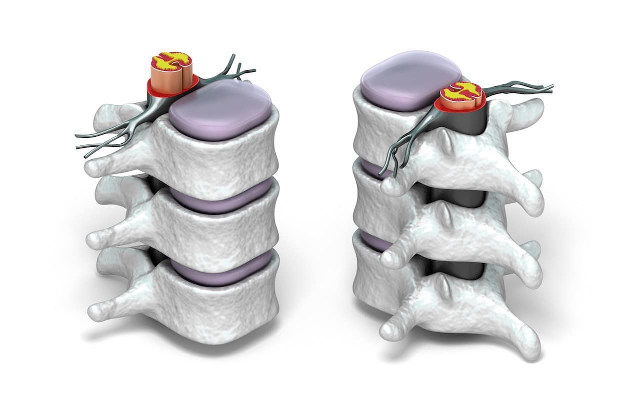Veelvoorkomende oorzaken van lage rugklachten √ Fysiopark